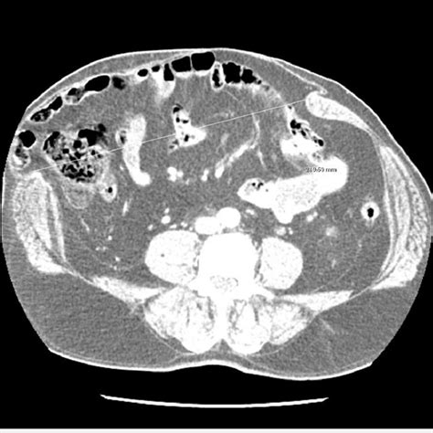 Axial Section Ct Image Of The Sample Patient With A Fascial Defect Of