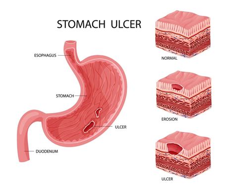 Erosion Skin Vs Ulcer Duodenal Ulcer Causes Symptoms And