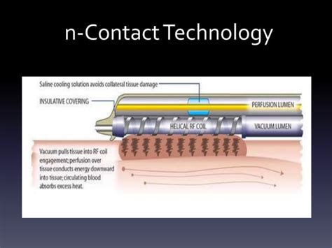 Convergent20 Ablation20without20movie Ppt