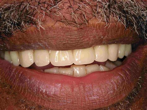 Dentures