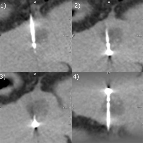 1 3 Three Individual Slices Out Of The Intrainterventional Ct Scan