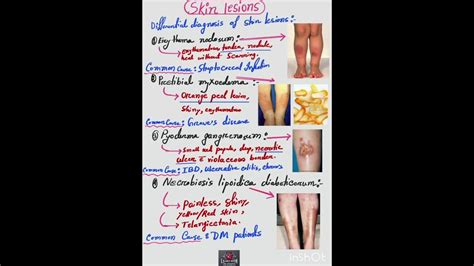 Differential Diagnosis Of Skin Lesions In Shin Youtube