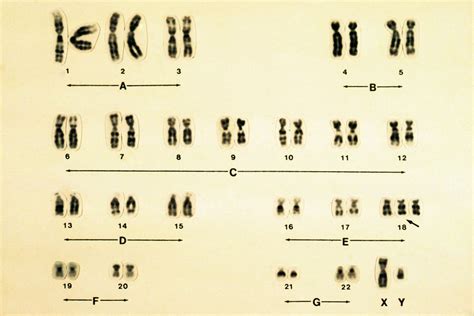 Ba Nhiễm Sắc Thể 18 Khoa Nhi Cẩm Nang Msd Phiên Bản Dành Cho