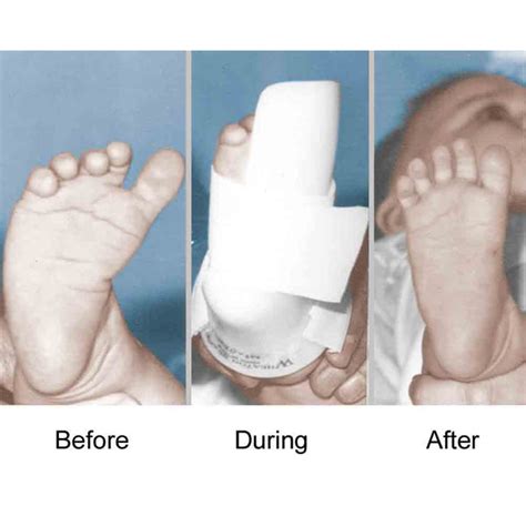 Wheaton Ctev Brace And Wheaton Mta Brace Wheaton Brace Ctev 9 15 Mo Devine Express