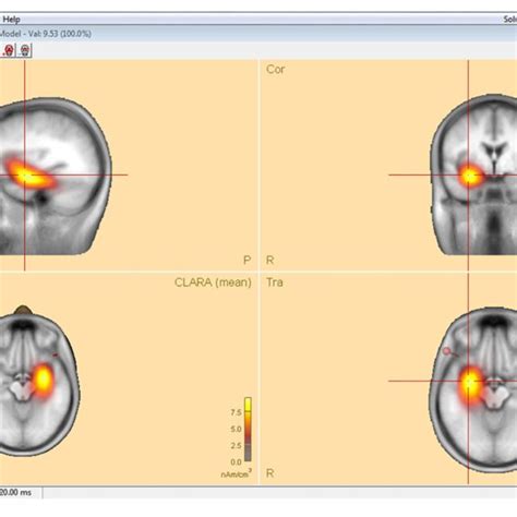classical loreta analysis recursively applied clara algorithm
