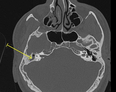 Chronic Mastoiditis Radiology Ct Scan And Mri