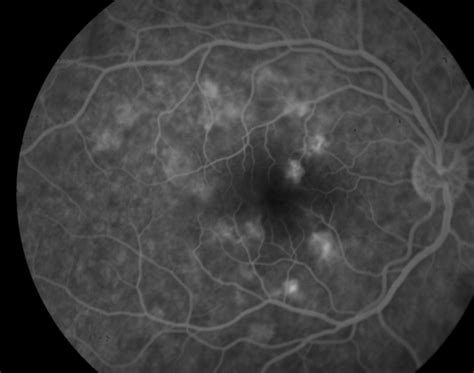 Interpret Fundus Fluorescein Angiography Defects On Angiograms