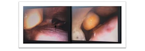 Endoscopic View Right Nostril Black Arrow Ethmoid Surgery The