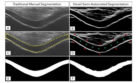 Description Of Manual And Semi Automated Femoral Cartilage Segmentation Download Scientific
