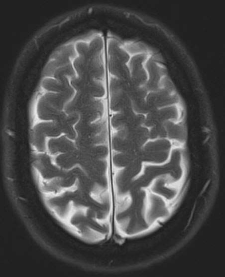 Subarachnoid Hemorrhage Mri Questions And Answers In Mri