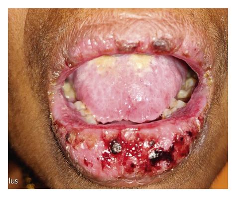 Erythema Multiforme Major Mouth