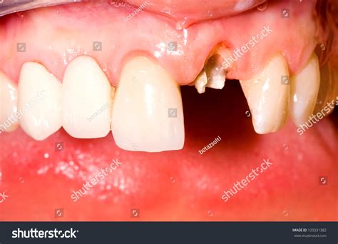 353 Crown Root Fracture Royalty Free Photos And Stock Images Shutterstock