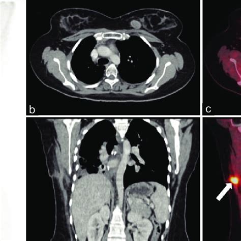 Histopathology A H And E B 200 Showed Malignant Spindle Cell Tumor