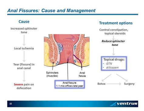 Ven 307 Diltiazem Cream Novel Treatment For Anal Fissures