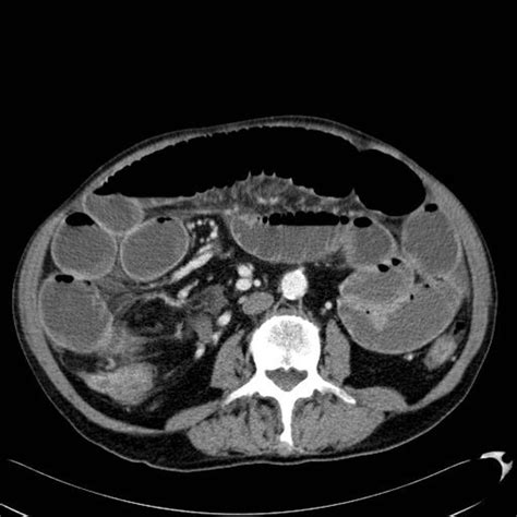 Small Bowel Obstruction Core Em