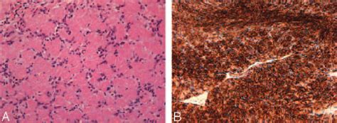 A Photomicrograph Shows The Tumor Specimen To Be Of Low Cellularity