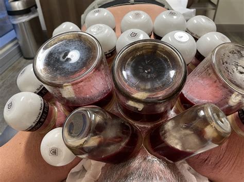 An Overview Of Cupping Therapy Modern Cupping Therapy
