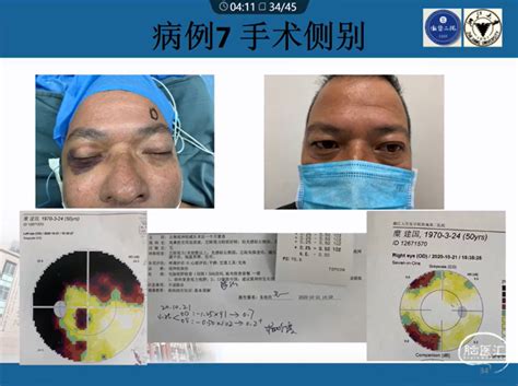 闫伟副主任医师：内镜下经鼻扩大视神经减压术的技巧与陷阱医学界 助力医生临床决策和职业成长