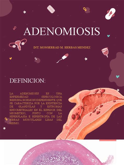 Adenomiosis Pdf