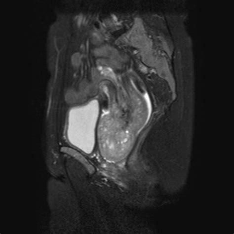 Non Puerperal Uterine Inversion Pacs