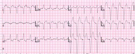Dr Smiths Ecg Blog Paced Rhythm Is There Ischemic St Elevation