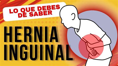 Hernia Inguinal Directa Vs Indirecta ¿cuáles Son Las Diferencias Clave