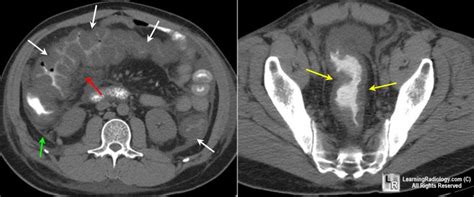 Ischemic Ischemic Colitis X Ray