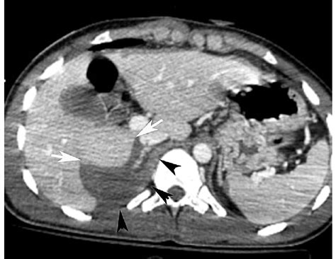 Axial Contrast Enhanced 64 Mdct Demonstrates Thickening Of The Right