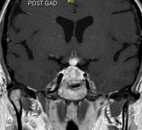 Granulomatous Hypophysitis Eurorad