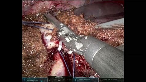 3 Different Robotic Left Lateral Sectionectomy 2 3 Bisegmentectomy