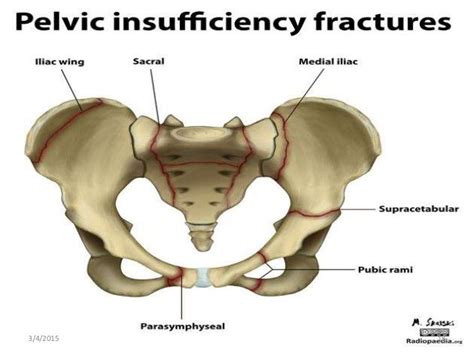 Pelvic Insufficiency Fracture