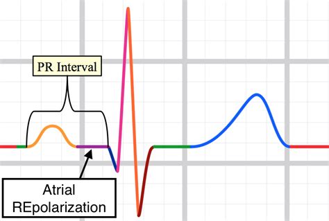 pr segment pericarditis