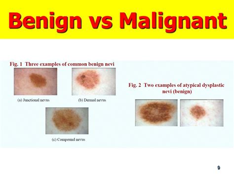Benign Nevus Vs Melanoma