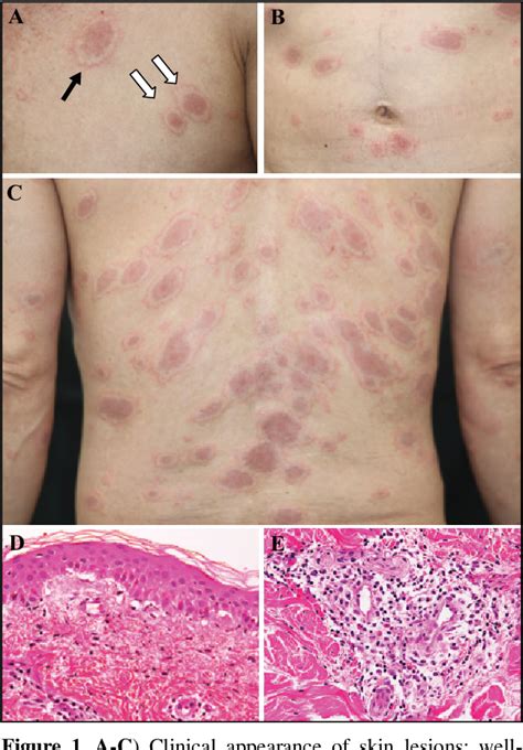 Pityriasis Rosea Christmas Tree Pattern