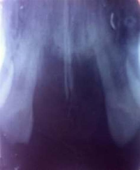 Pre Operative Radiograph Download Scientific Diagram