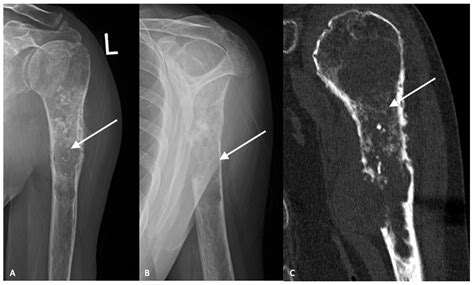 Chondrosarcoma A Clinical Review
