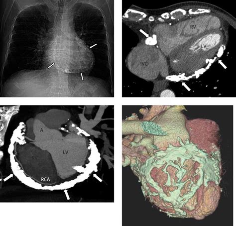 Chronic Constrictive Pericarditis Zeina 2010 Clinical Cardiology Wiley Online Library