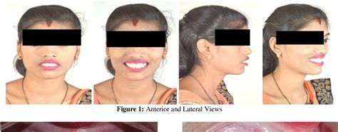 Figure 1 From Surgical Lip Repositioning An Interdisciplinary Approach