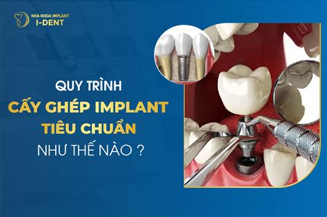 Quy Trình Trồng Răng Implant Đúng Chuẩn Nha Khoa I Dent