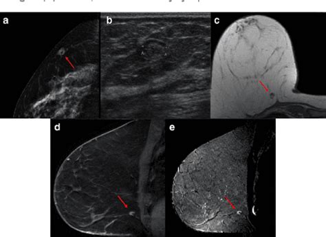 Intramammary Lymph Nodes Normal And Abnormal Multimodality Imaging