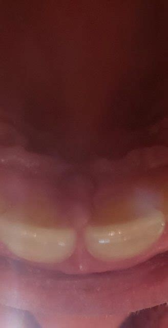 Incisive Papilla Inflammation