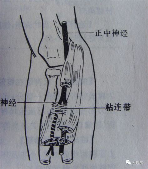 骨科常见11种神经卡压综合征，看看你会诊治几种！ 好医术文章 好医术 赋能医生守护生命