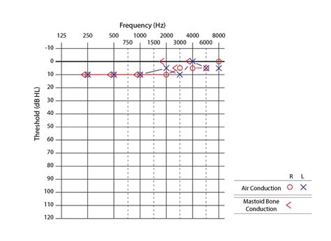 Image Audiogram Of Right Ear In A Patient With Normal Hearing Msd Manual Professional Edition