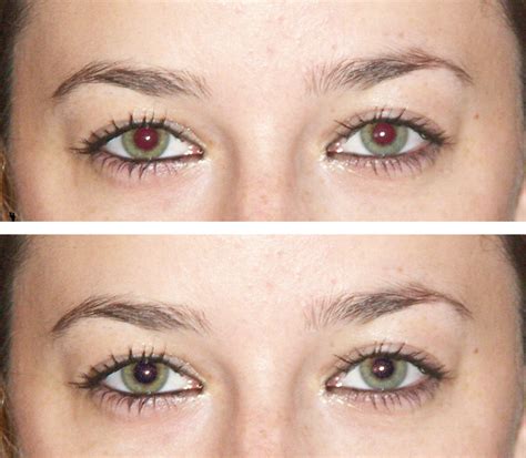 Automatic And Accurate Red Eye Removal With Cloudinary