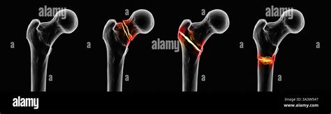 Illustration Of Femur Fracture Types Normal Femur Femoral Neck