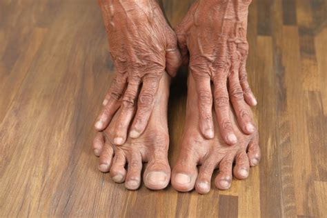 Artritis del pie causas síntomas y tratamientos para aliviar el dolor