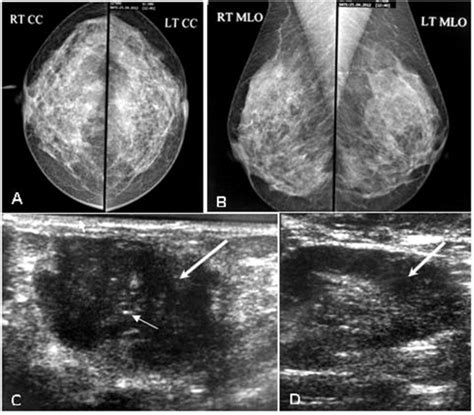 29 Y Old Female Presented With Palpable Left Breast Mass A And B