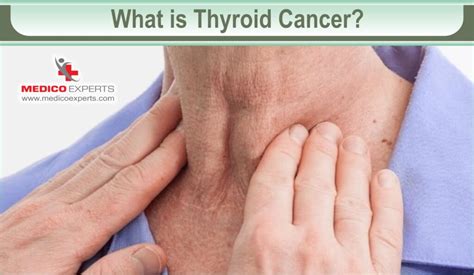 How Can Thyroid Cancer Be Cured Things You Should Know