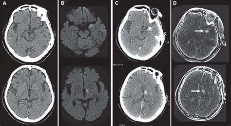 A 92 Year Old Female Case 1 Ct Adiffusion Weighted Imaging B