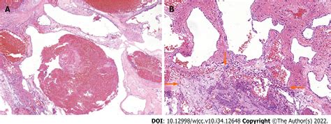Figure 1 From Atypical Aggressive Vertebral Hemangioma Of The Sacrum